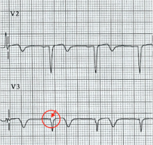 Recent M I Ecg Guru Instructor Resources